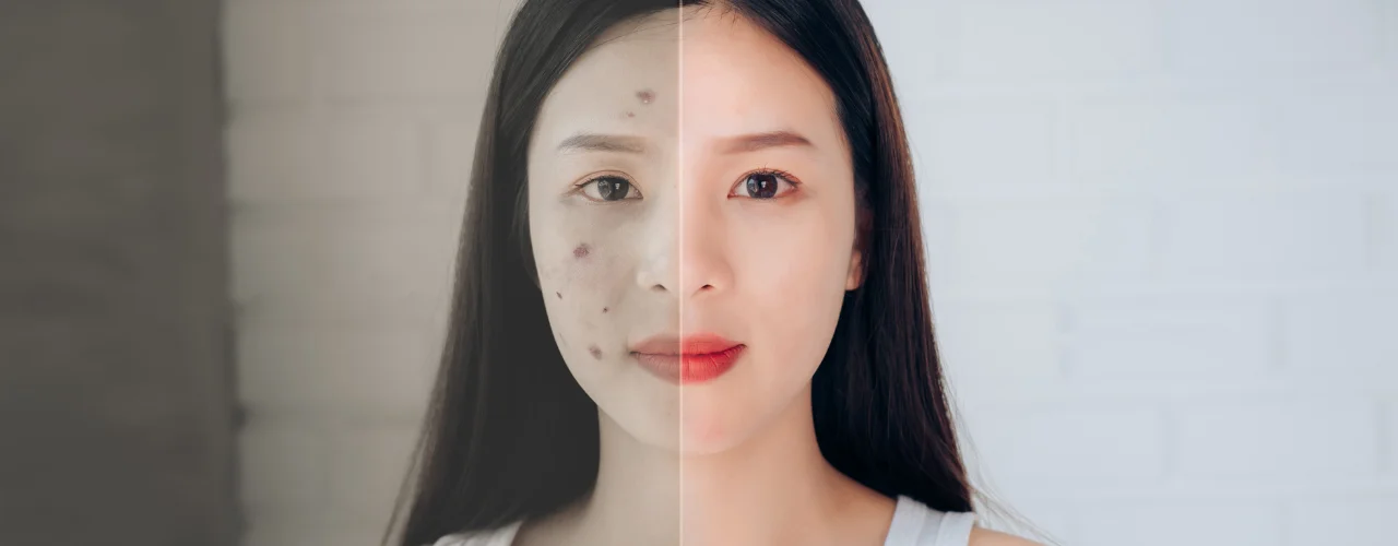 ACNI SOL Face Wash: Solution for Acne-Free, Oily Skin